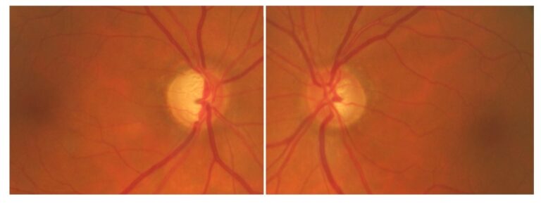 Glaucome : traitement, soin, opération à Bordeaux, 33 - Clinique des Yeux