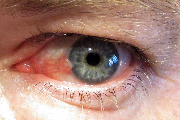 Ptérygion - Clinique des Yeux Bordeaux