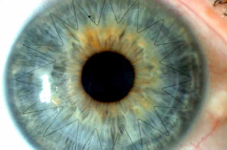 Greffe de cornée - Clinique des Yeux Bordeaux