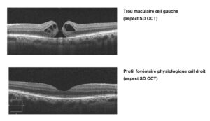 Trou maculaire : diagnostic et traitement - Clinique des yeux Bordeaux