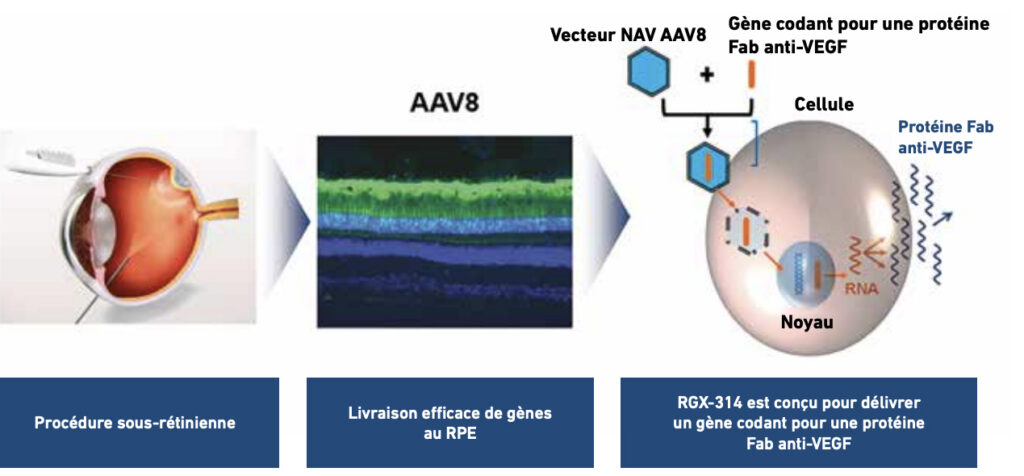 Les nouvelles formes de délivrance des anti-VEGF : PDS et thérapie ...